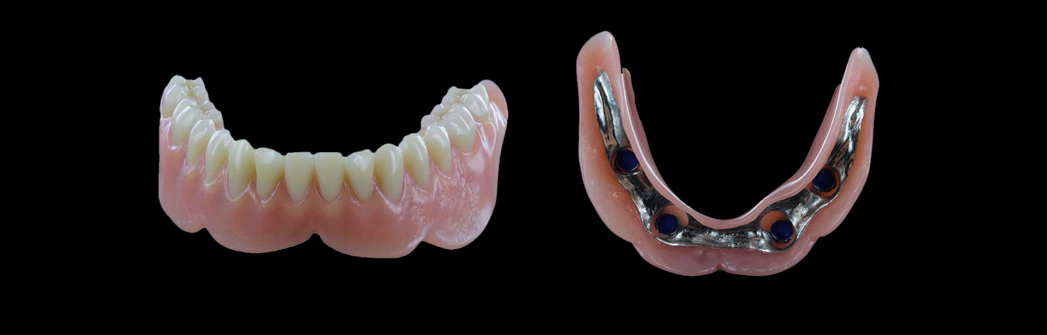 Partiële prothese - Labo De Witte - partner van de tandarts